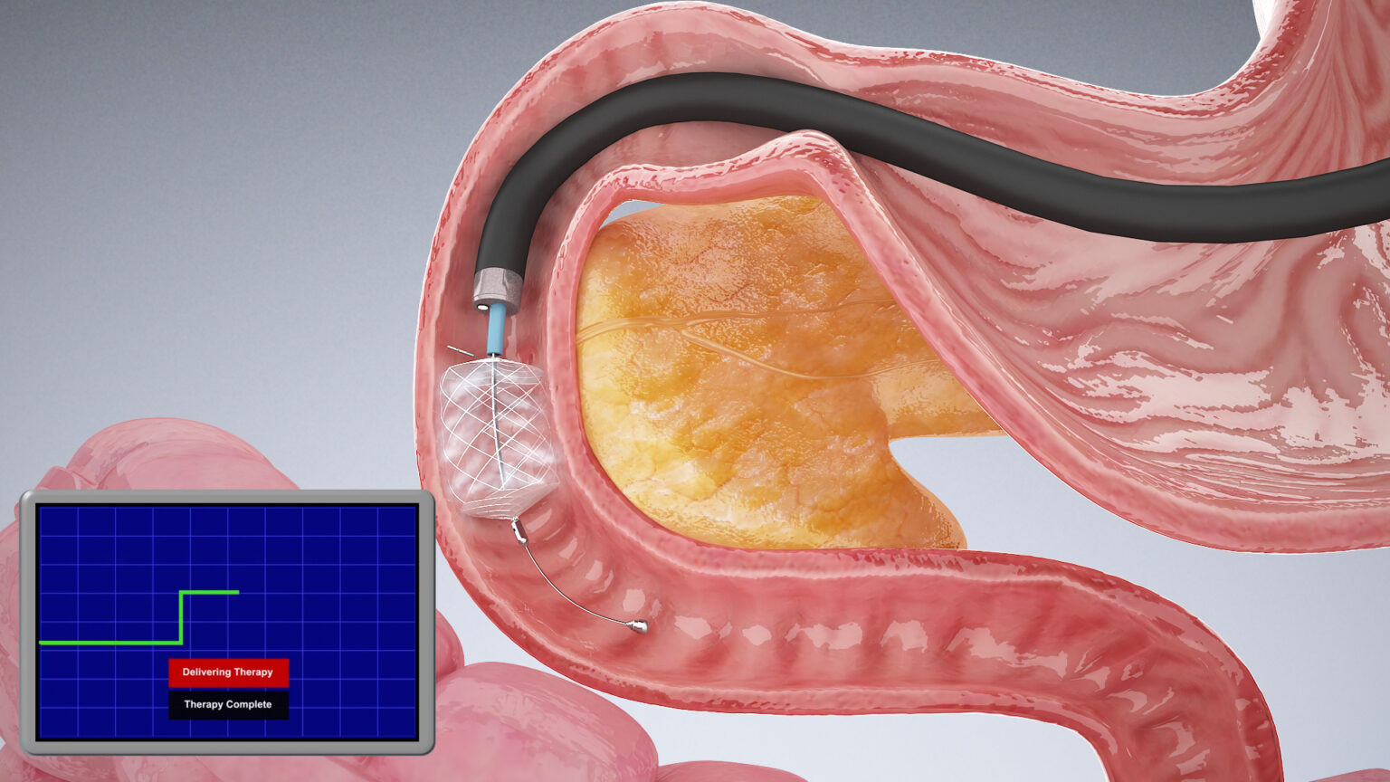 RF Vapor Ablation - Aqua Medical